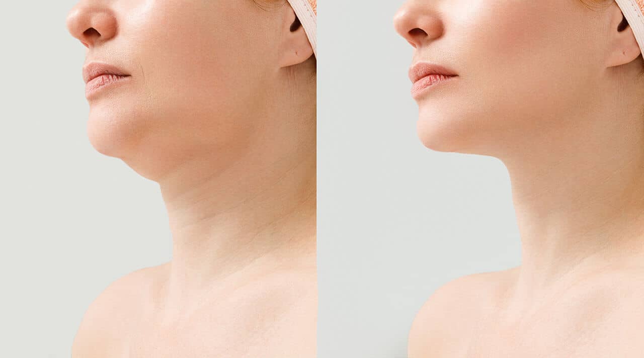 The Subtle Power of Chin Liposuction Procedures