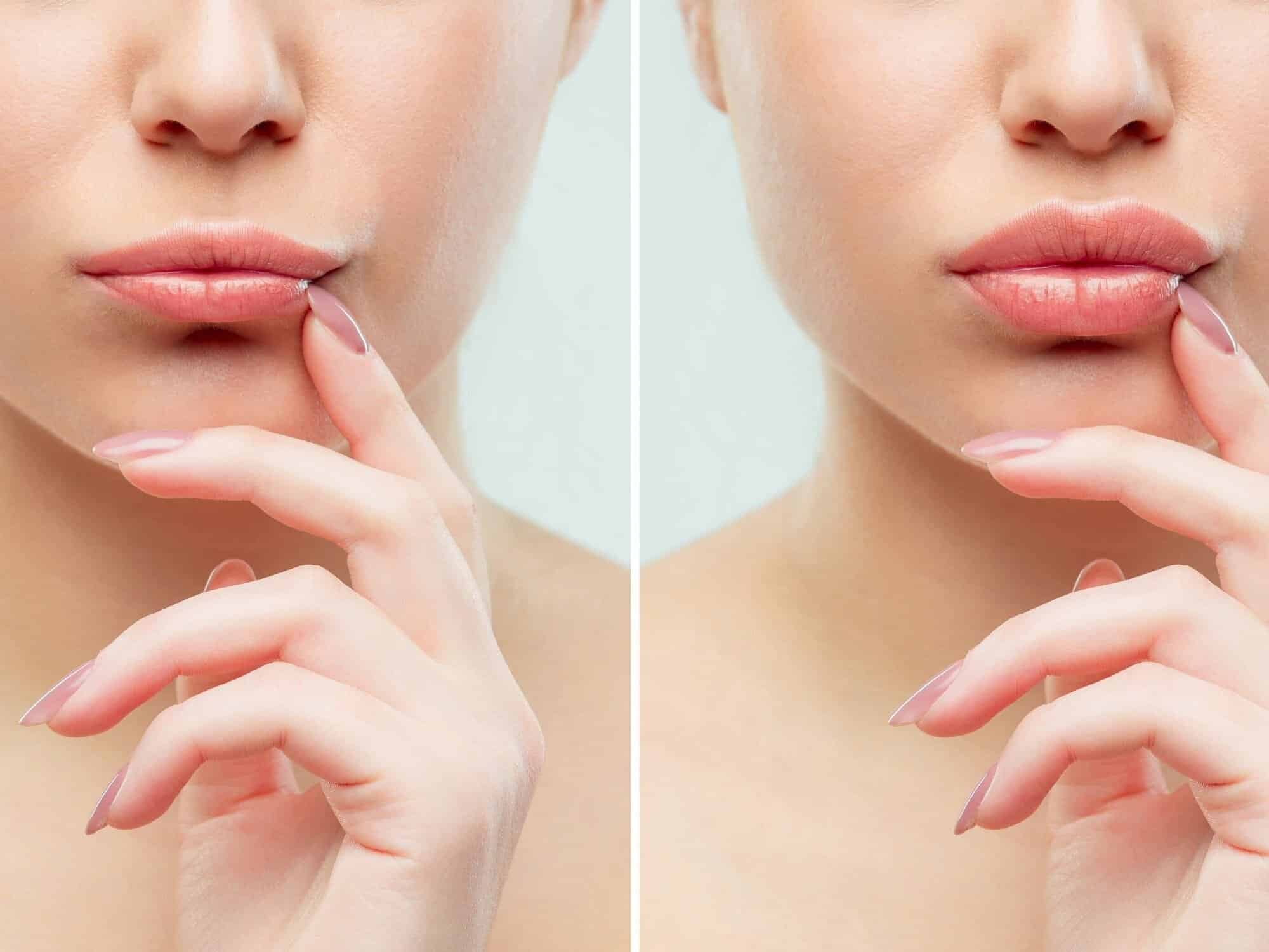 Exploring Lip Augmentation with Hyaluronic Acid
